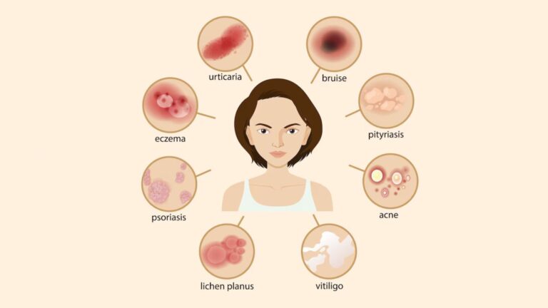 Why Do Skin Tags Develop And How to Remove Them