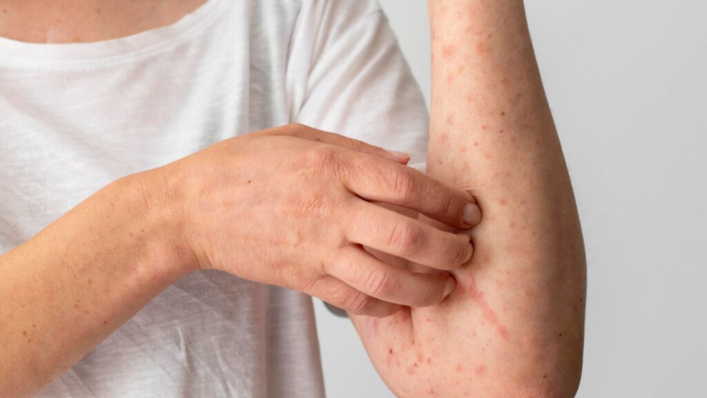 Skin Rashes: Causes, Symptoms, Red Flags and Treatment