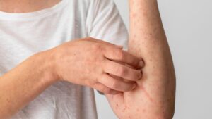Skin Rashes: Causes, Symptoms, Red Flags and Treatment